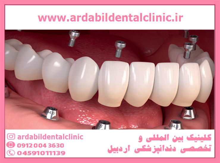 همه چیز در خصوص اوردنچر - کلینیک دندان پزشکی اردبیل